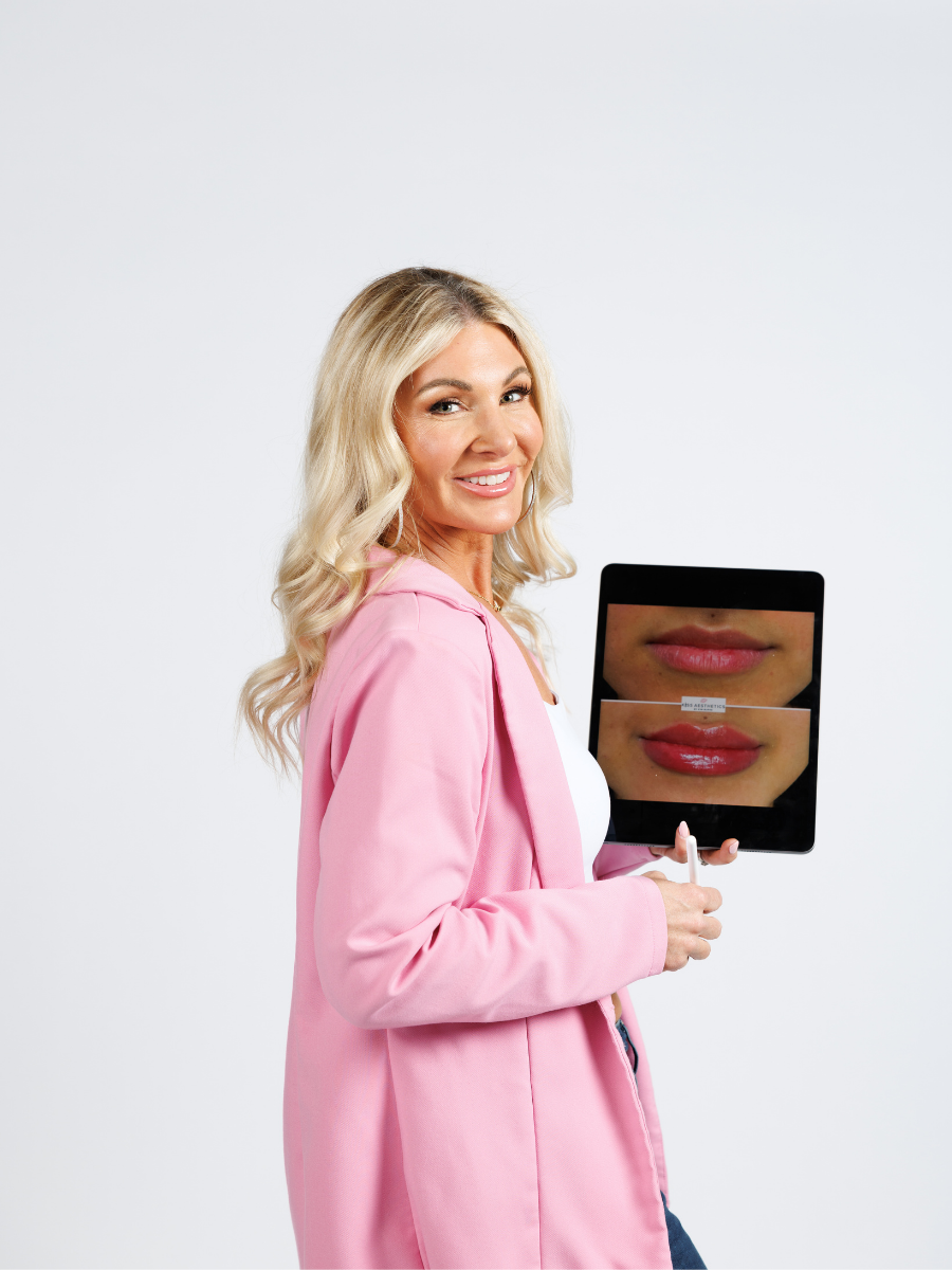 Signature Lip Filler in Minooka & Tinley Park | Kiss Aesthetics