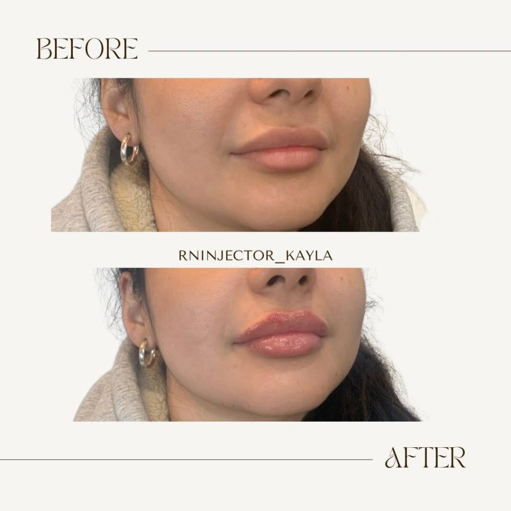 Signature Lip Filler | Kiss Aesthetics